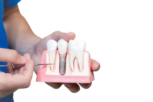 ¿Qué es un Implante Dental Mono? | Implantes dentales en Las Vegas ¿Qué es un Implante Dental Mono? | Implantes dentales en Las Vegas